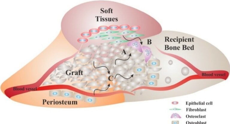 Bone Grafting Materials: Comparative Analysis - Digital Dentistry Schoology
