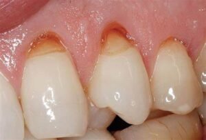 Tooth Wear: Causes, Management, and Treatment Plans for Modern Dental ...