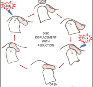 TMJ Disc Displacement with and without Reduction: Diagnosis, Treatment ...