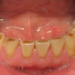 Tooth Wear: Causes, Management, and Treatment Plans for Modern Dental ...