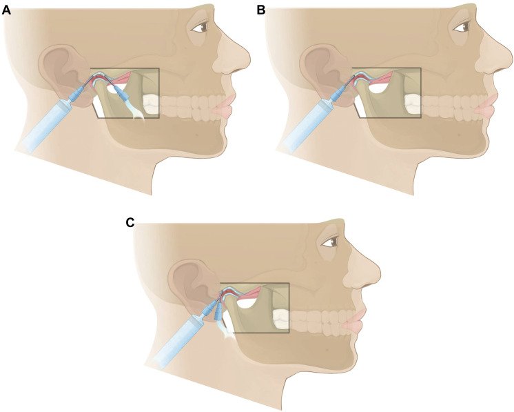 TMJ Disc Displacement with and without Reduction: Diagnosis, Treatment ...