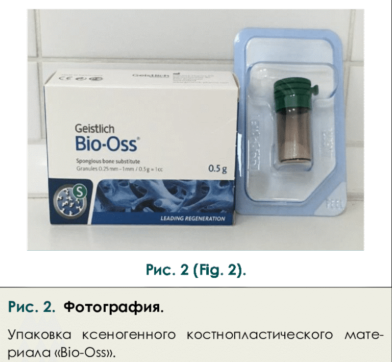 Bone Grafting Materials: Comparative Analysis - Digital Dentistry Schoology