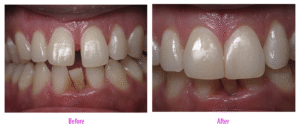 Managing Tooth Proportions for Harmonious Smiles: A Comprehensive Guide ...