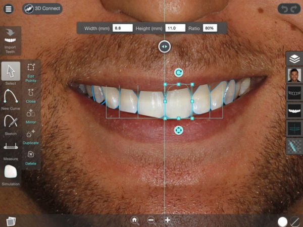 Managing Tooth Proportions for Harmonious Smiles: A Comprehensive Guide ...