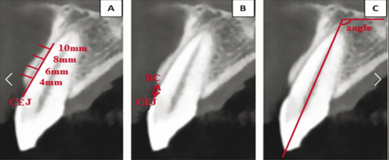 Digital Implant Planning with Surgical Guides: A Comprehensive Guide ...