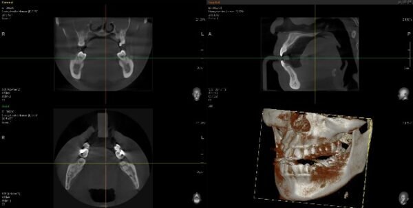 TMJ Disc Displacement with and without Reduction: Diagnosis, Treatment ...