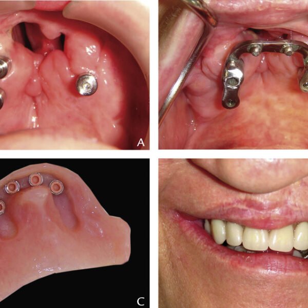 Digital Innovation in Maxillofacial Prosthetics: CAD/CAM Implant ...