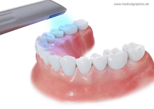 Top 3 Proven Techniques for Occlusal Rest Seat Preparation in Removable ...